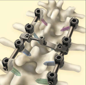 Posterior Lumbar Spine Fixation - Advantage Medical