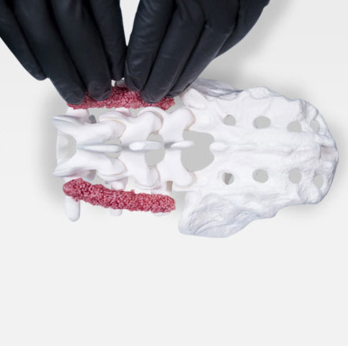 Tutoplast Patch Graft