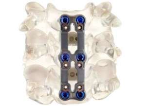 Cervical Plate - Advantage Medical