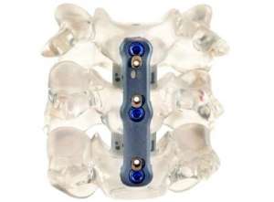 Midline Cervical Plate - Advantage Medical