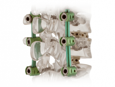 Pedicle Screw System - Advantage Medical