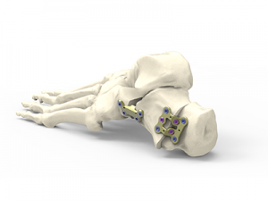 Plating System - Advantage Medical