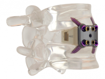 Standalone ALIF - Advantage Medical