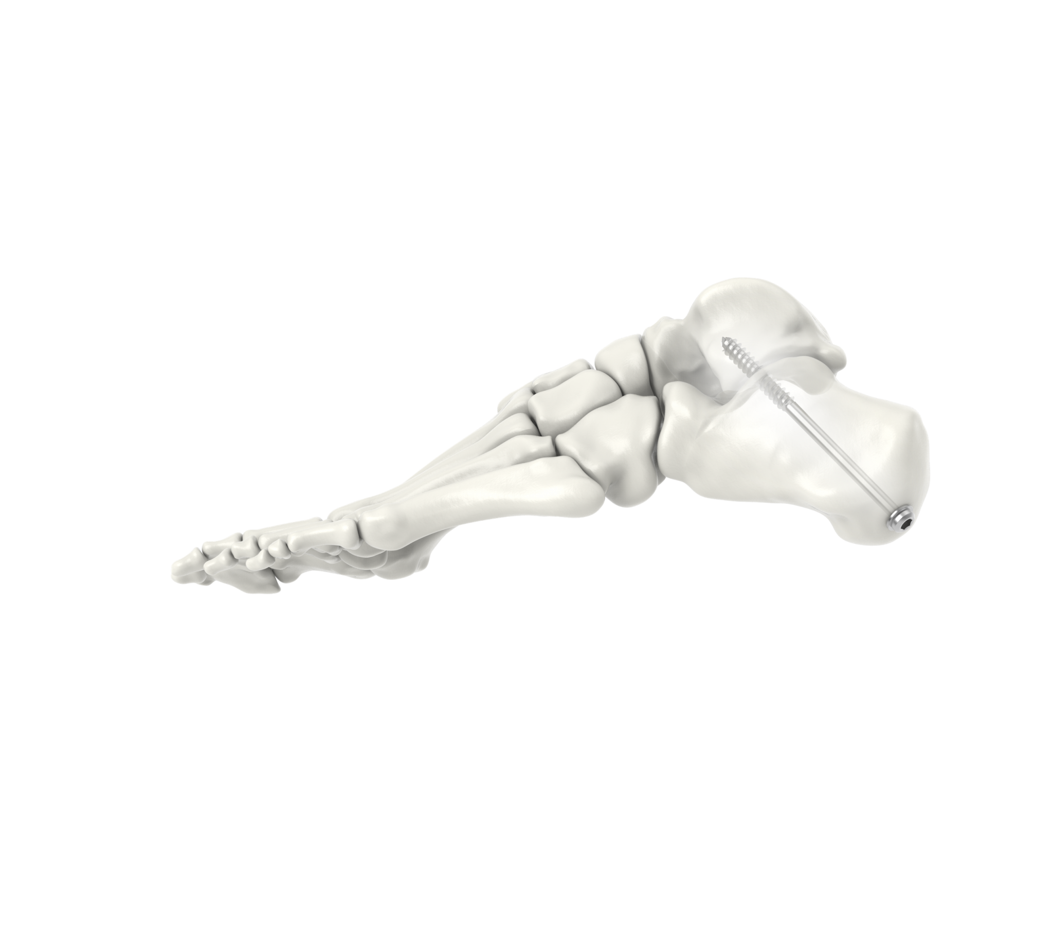 Inlet™ Cannulated & Headless Screw System - Advantage Medical