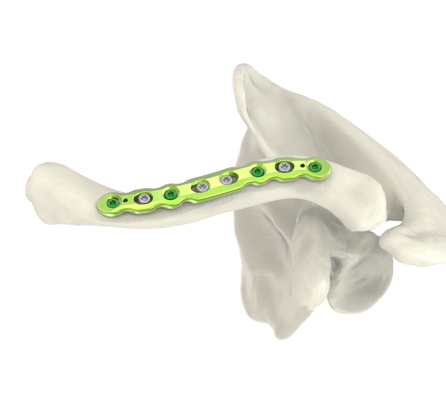 Inlet™ Clavicle Plating System - Advantage Medical