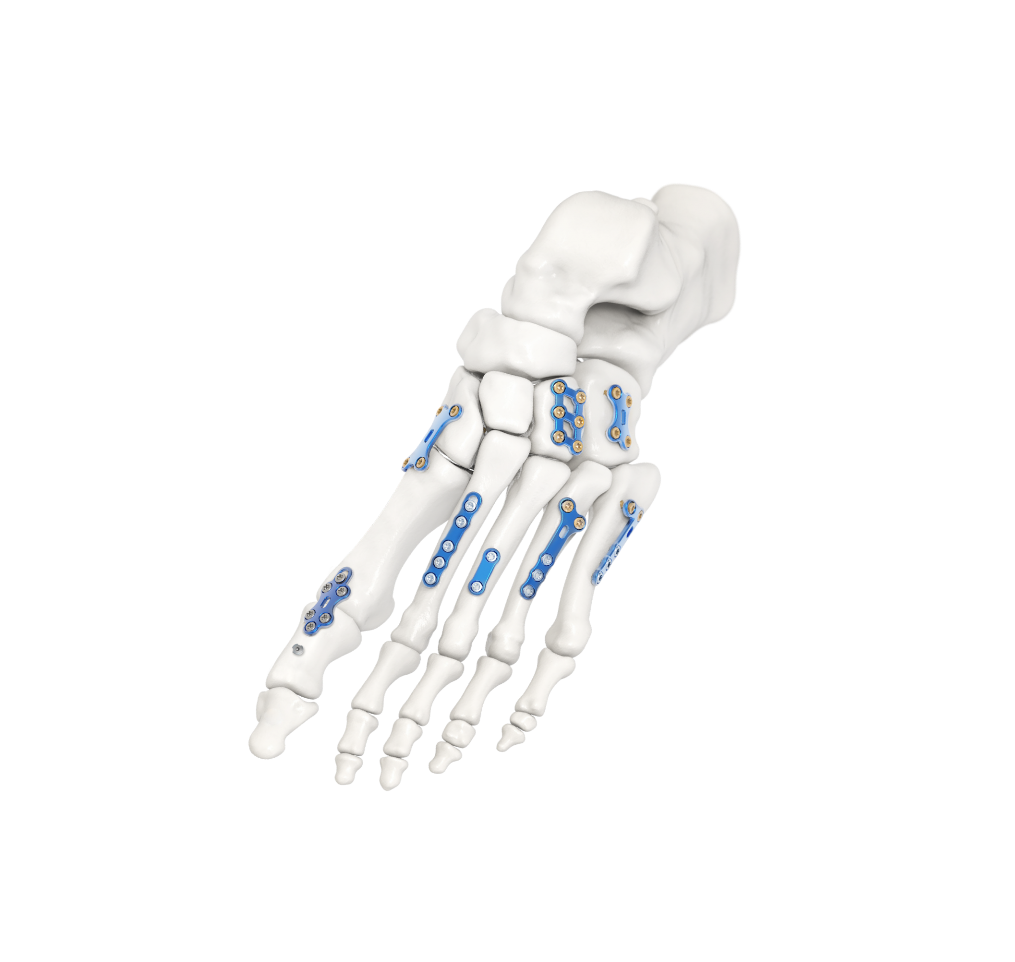 Inlet™ Foot Plating System - Advantage Medical