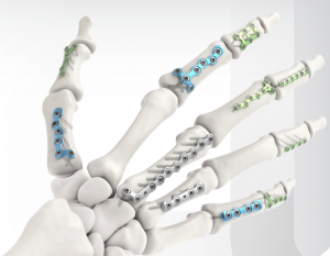 Inlet™ Hand Plating System - Advantage Medical