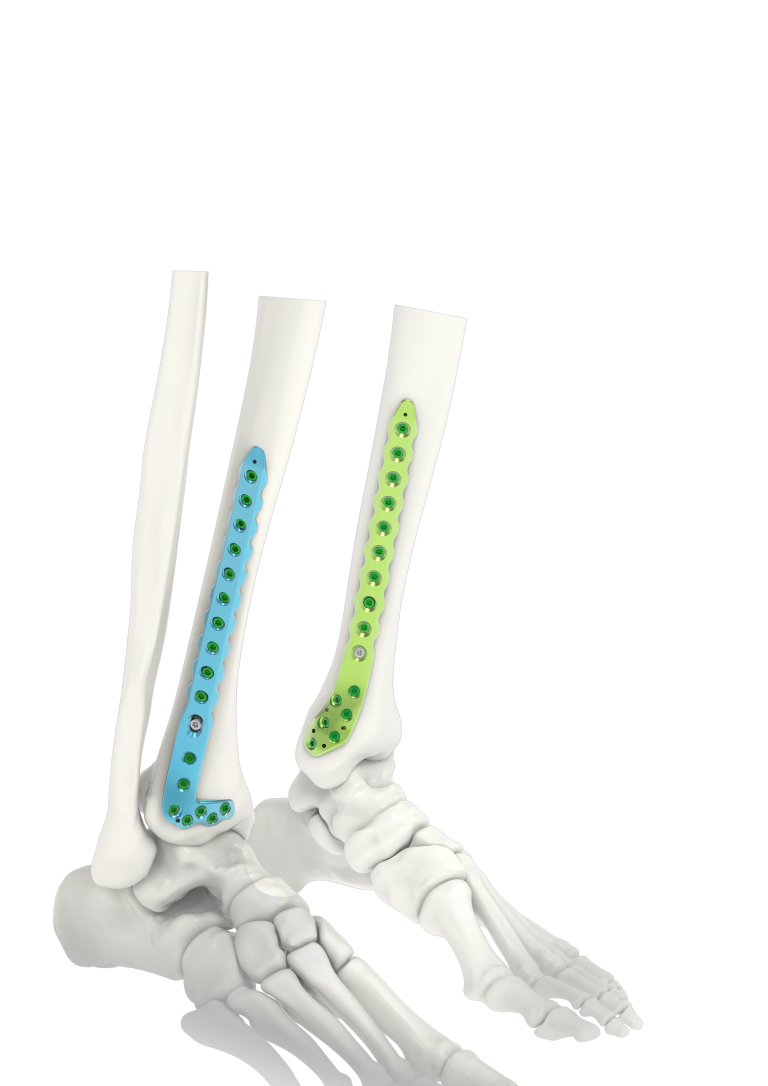 Inlet™ Distal Tibia Plating System - Advantage Medical