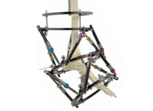 Circular Fixation System - Advantage Medical