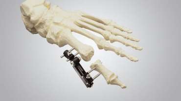 Rail Fixator System - Advantage Medical